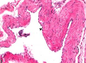 Esophagus - Angiectasis - Nonneoplastic Lesion Atlas