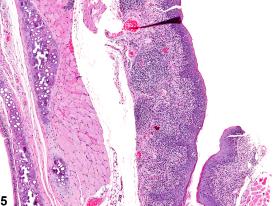 Esophagus - Inflammation - Nonneoplastic Lesion Atlas