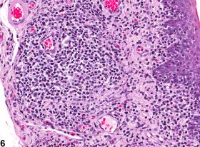 Esophagus - Inflammation - Nonneoplastic Lesion Atlas
