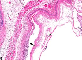 Esophagus - Ulcer - Nonneoplastic Lesion Atlas
