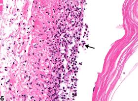 Esophagus - Ulcer - Nonneoplastic Lesion Atlas