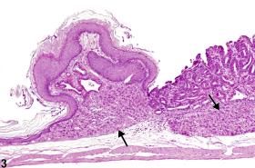 Stomach - Ectopic Tissue - Nonneoplastic Lesion Atlas