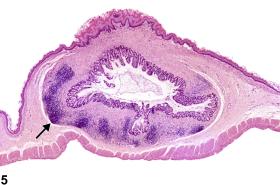 Stomach - Ectopic Tissue - Nonneoplastic Lesion Atlas