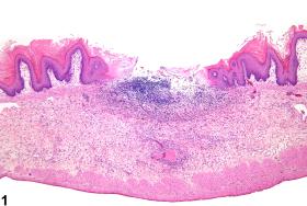 Stomach - Ulcer - Nonneoplastic Lesion Atlas