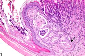 Stomach - Metaplasia, Squamous - Nonneoplastic Lesion Atlas