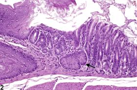 Stomach - Metaplasia, Squamous - Nonneoplastic Lesion Atlas