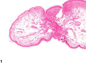 Tongue - Edema - Nonneoplastic Lesion Atlas