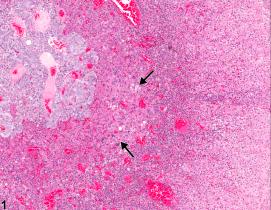 adrenal glands - Cortex - Cellular Atypia - Nonneoplastic Lesion Atlas
