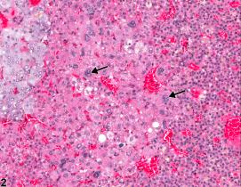 adrenal glands - Cortex - Cellular Atypia - Nonneoplastic Lesion Atlas