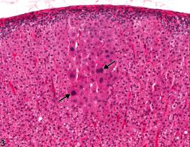 adrenal glands - Cortex - Cellular Atypia - Nonneoplastic Lesion Atlas