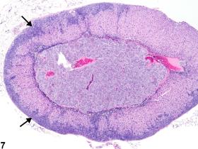 Adrenal Gland, Cortex - Hyperplasia, Subcapsular - Nonneoplastic Lesion ...