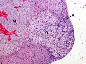 Adrenal Gland, Cortex - Hyperplasia, Subcapsular - Nonneoplastic Lesion ...