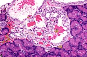Pancreatic islets - Angiectasis - Nonneoplastic Lesion Atlas