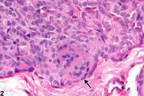 Parathyroid gland - Syncytial Giant Cell - Nonneoplastic Lesion Atlas