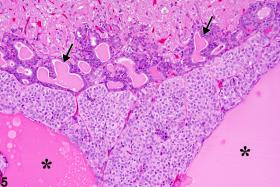 Pituitary gland - Cyst - Nonneoplastic Lesion Atlas