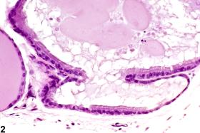 Thyroid gland - Cyst, Congenital - Nonneoplastic Lesion Atlas