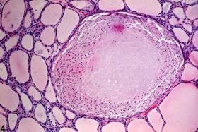 Thyroid gland - Cyst, Congenital - Nonneoplastic Lesion Atlas