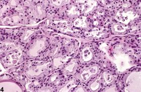 Thyroid Gland, Follicular Cell - Hypertrophy - Nonneoplastic Lesion Atlas