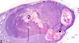 Clitoral gland - Inflammation - Nonneoplastic Lesion Atlas