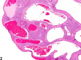 Ovary - Angiectasis - Nonneoplastic Lesion Atlas