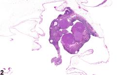 Ovary, Bursa - Cyst - Nonneoplastic Lesion Atlas
