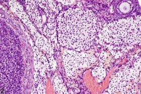 Ovary, Interstitial Cell - Hyperplasia - Nonneoplastic Lesion Atlas