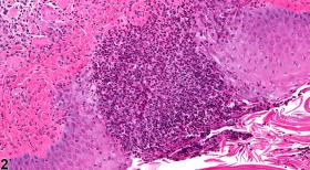 Vagina - Ulcer - Nonneoplastic Lesion Atlas