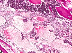 Bone marrow - Angiectasis - Nonneoplastic Lesion Atlas