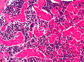 Bone marrow - Angiectasis - Nonneoplastic Lesion Atlas