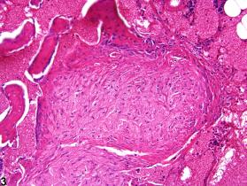 Bone marrow - Fibrosis - Nonneoplastic Lesion Atlas