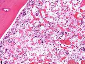 Bone marrow - Gelatinous Transformation - Nonneoplastic Lesion Atlas