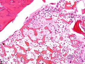 Bone marrow - Gelatinous Transformation - Nonneoplastic Lesion Atlas
