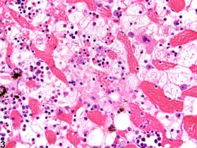 Bone marrow - Gelatinous Transformation - Nonneoplastic Lesion Atlas