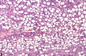 Bone marrow - Hypocellularity - Nonneoplastic Lesion Atlas