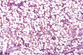 Bone marrow - Hypocellularity - Nonneoplastic Lesion Atlas