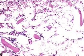 Bone marrow - Hypocellularity - Nonneoplastic Lesion Atlas