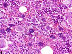 Bone marrow - Infiltration Cellular, Mast Cell - Nonneoplastic Lesion Atlas