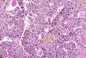 bone marrow - Pigment - Nonneoplastic Lesion Atlas