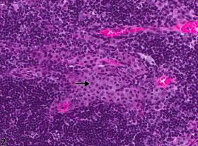 Lymph node - Hyperplasia, Mast Cell - Nonneoplastic Lesion Atlas
