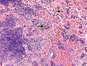 Lymph node - Pigment - Nonneoplastic Lesion Atlas