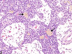 Lymph node - Pigment - Nonneoplastic Lesion Atlas