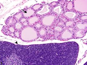 Thymus - Ectopic Tissue - Nonneoplastic Lesion Atlas