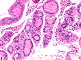 Coagulating gland - Atrophy - Nonneoplastic Lesion Atlas