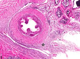 Ductus deferens - Inflammation - Nonneoplastic Lesion Atlas