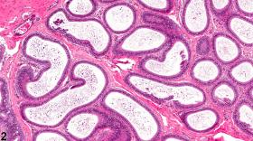 Epididymis, Duct - Exfoliated Germ Cell - Nonneoplastic Lesion Atlas
