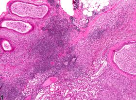 Epididymis - Inflammation - Nonneoplastic Lesion Atlas