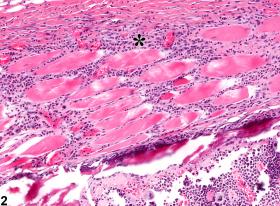 Penis - Inflammation - Nonneoplastic Lesion Atlas