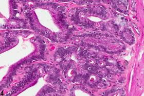 Seminal Vesicle, Epithelium - Hyperplasia - Nonneoplastic Lesion Atlas