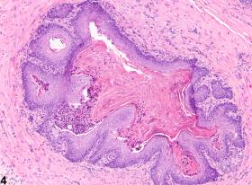 Seminal vesicle - Inflammation - Nonneoplastic Lesion Atlas