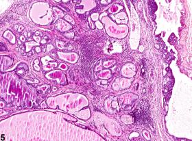Seminal vesicle - Inflammation - Nonneoplastic Lesion Atlas